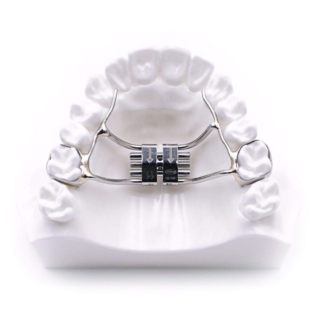 Everything You Need to Know About Palatal Expanders